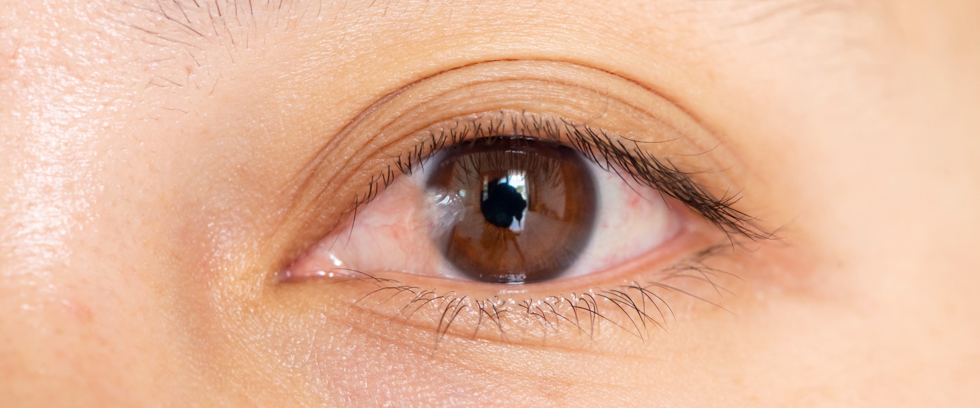 Pterigión, Carnosidad Ocular: Síntomas, Causas y Tratamiento