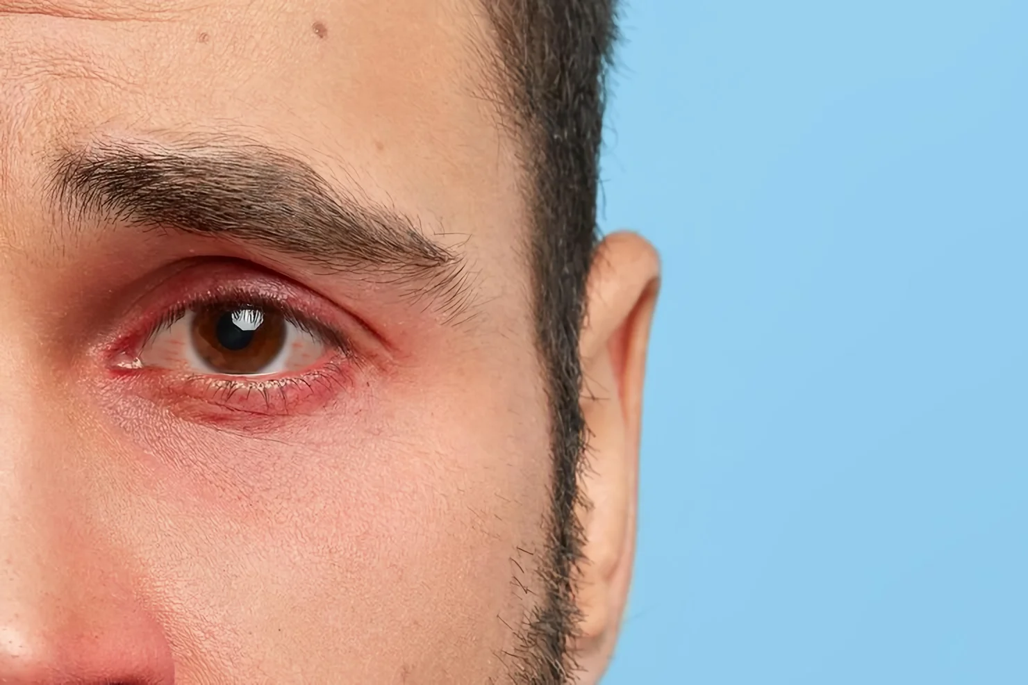 Síndrome del Ojo Seco: ¿Qué Es y Cómo Tratarlo?